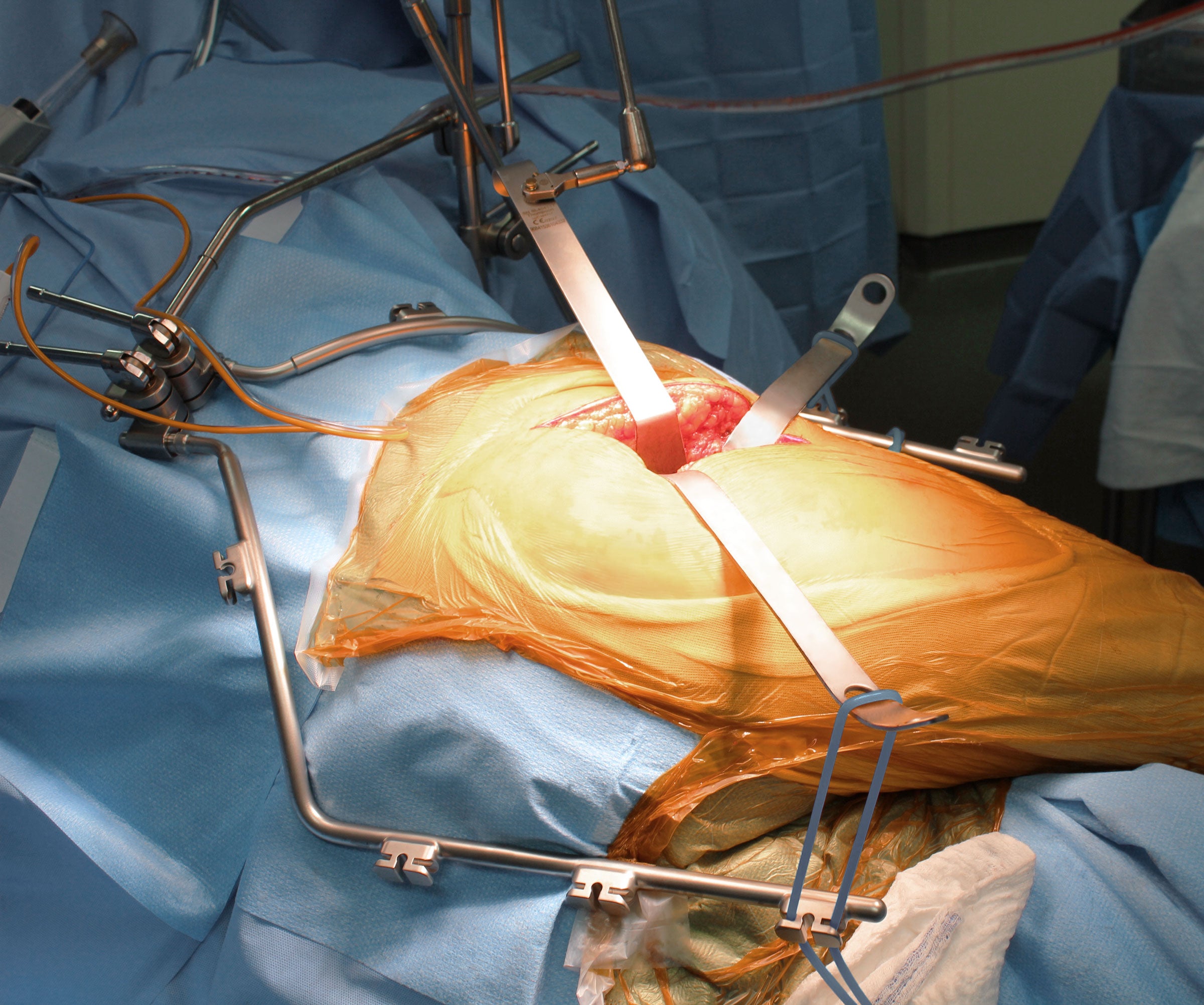 Hip Retractor | Orthopedic | Thompson Retractor – Thompson Surgical